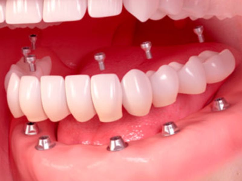 Única Odontologia - Prótese protocolo